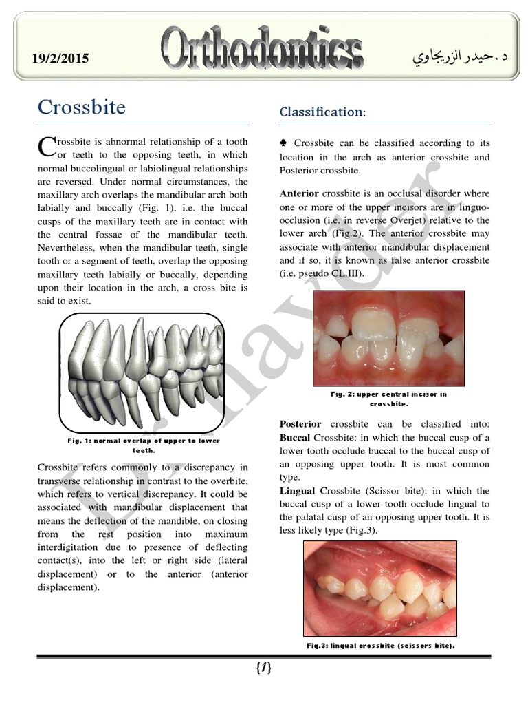 Lingual Crossbite Vs Buccal Crossbite