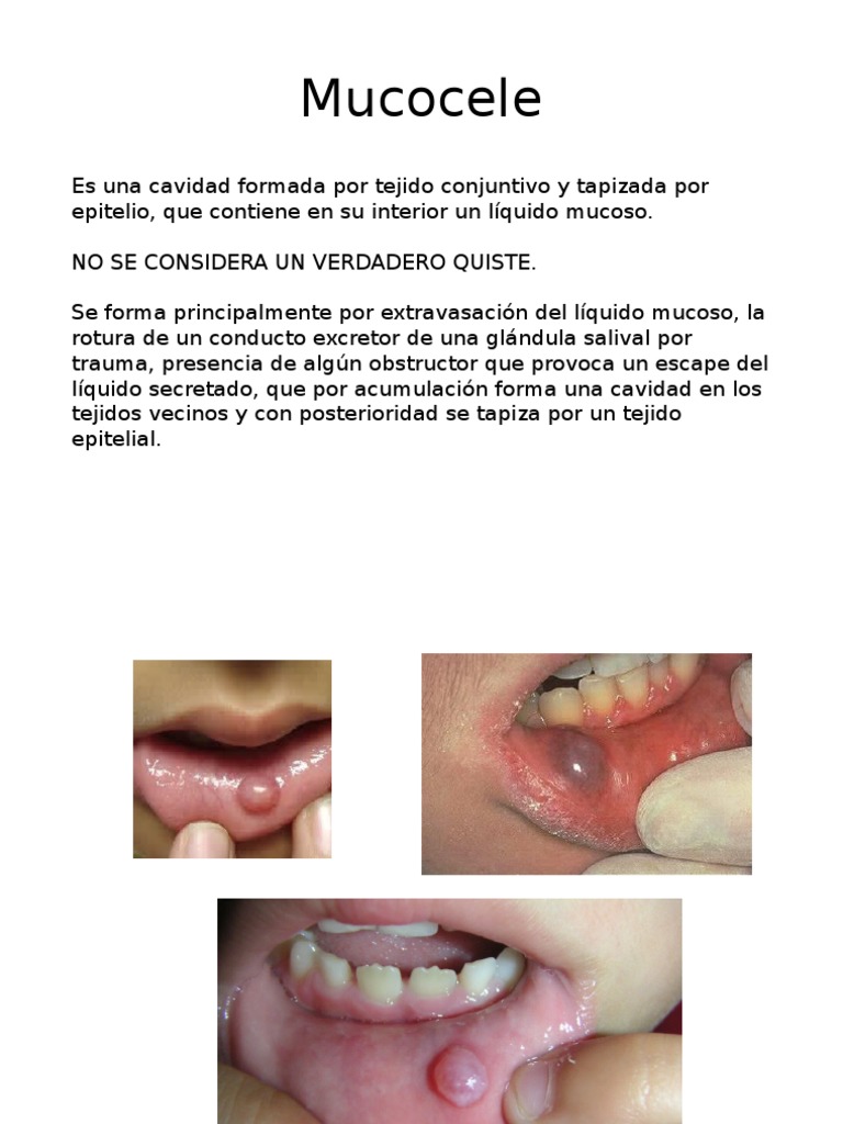 Iniciación Mucocele Ranula Sialolitiasis | Anatomía | Especialidades ...