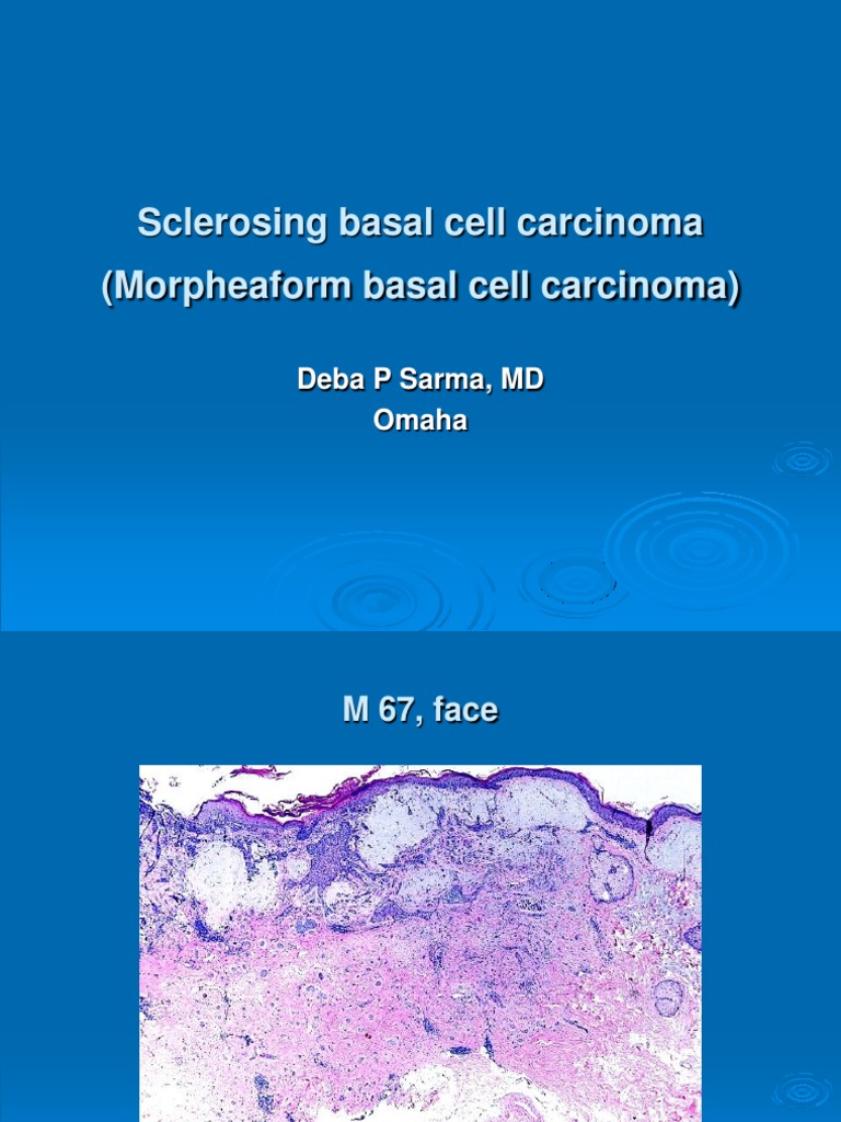 Sclerosing Basal Cell Carcinoma (Morpheaform Basal Cell Carcinoma) . | PDF