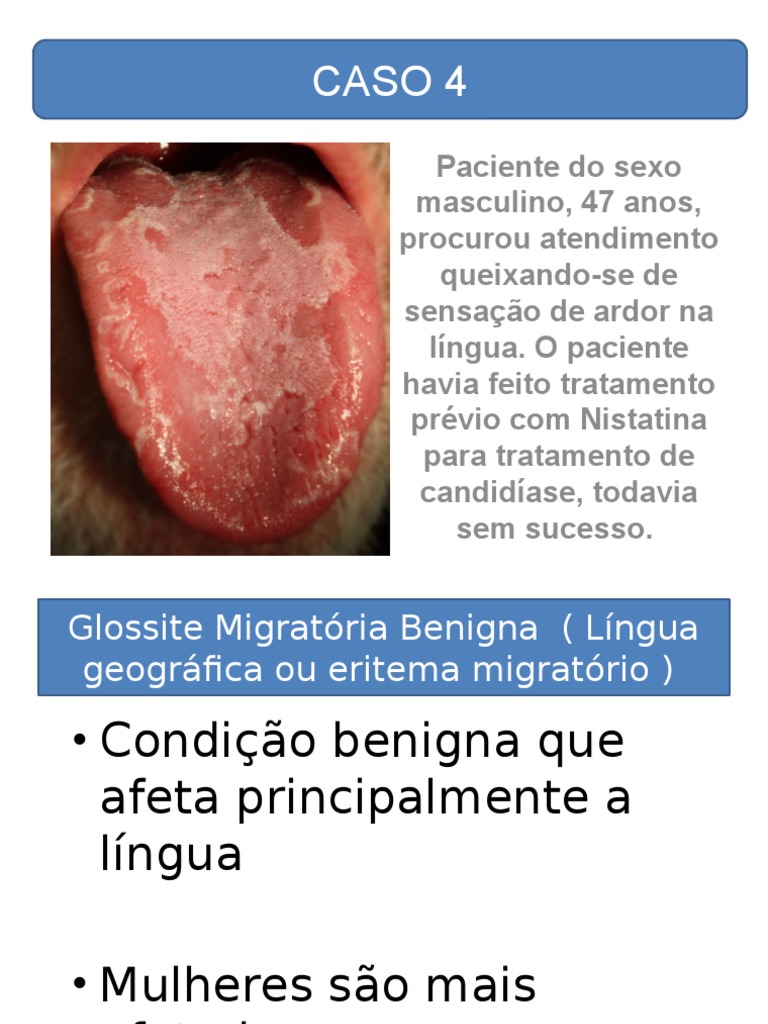 Patologia Oral - Glossite Migrátoria Benigna | PDF
