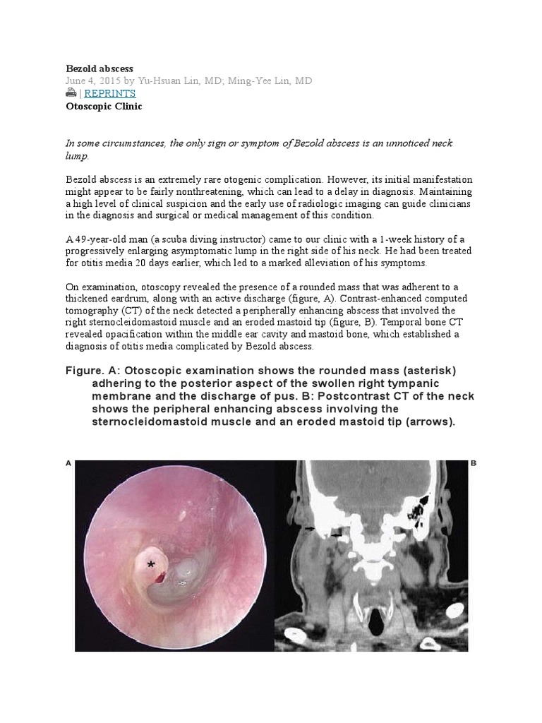 Bezold Abscess | PDF | Ear | Medical Specialties