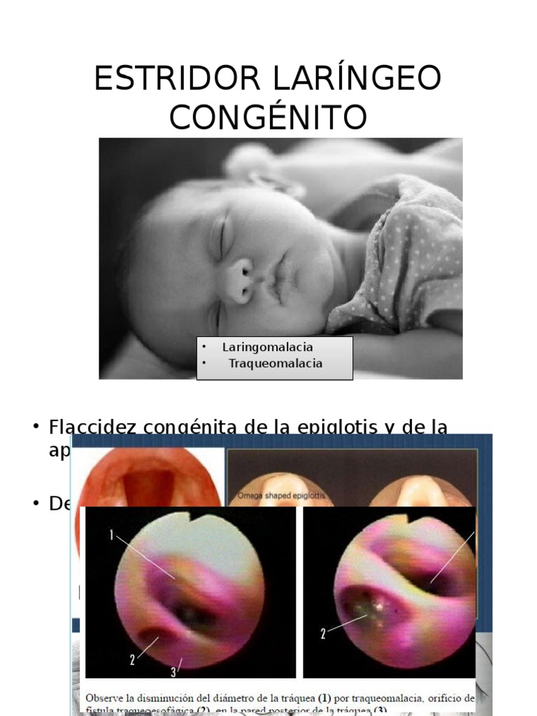 Estridor Laríngeo Congénito | PDF