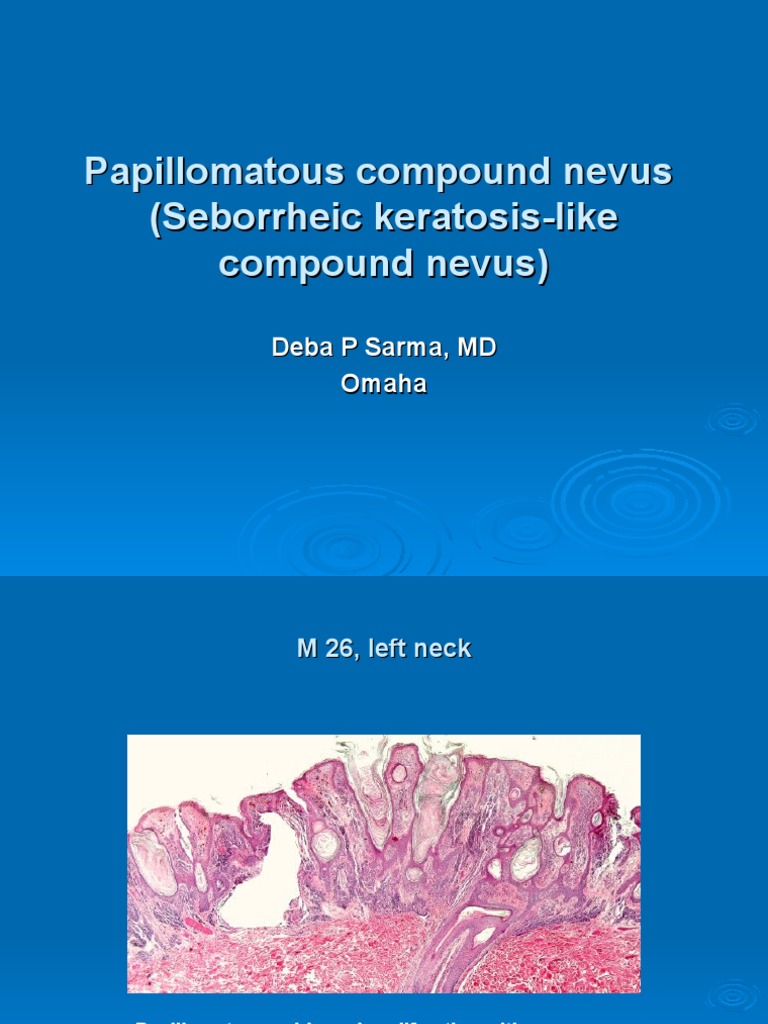 Papillomatous Compound Nevus (Seborrheic Keratosis-Like Compound Nevus ...