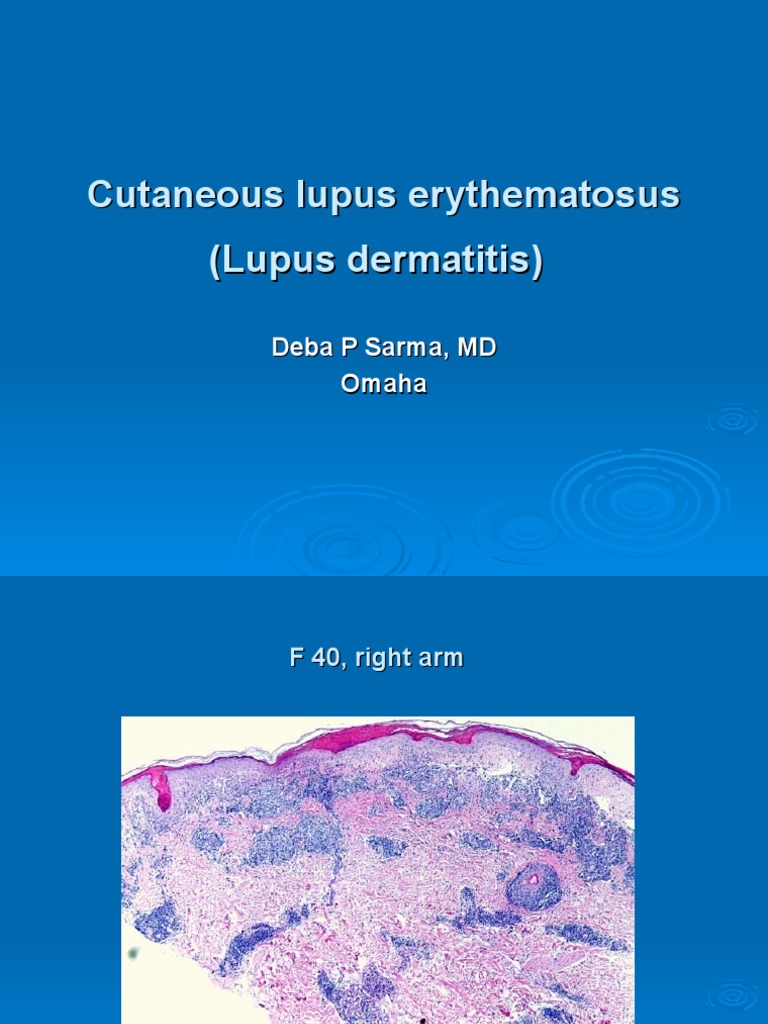 Cutaneous Lupus Erythematosus (Lupus Dermatitis), F 40, Right Arm. | PDF