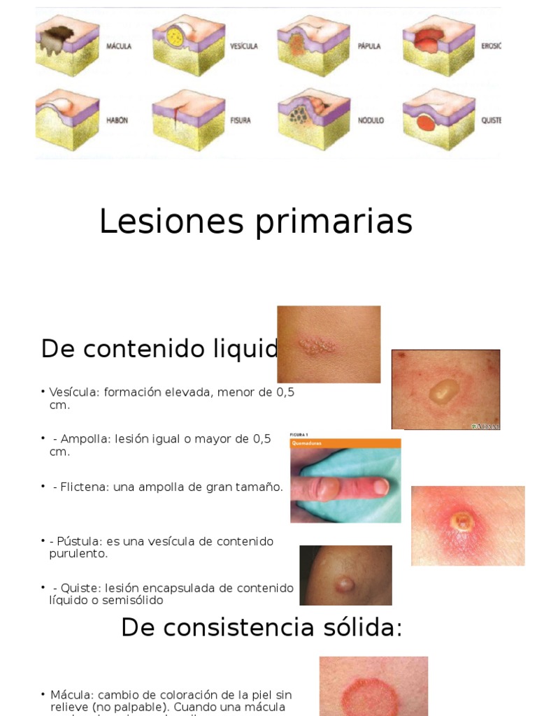 Lesiones Primarias Dermatologia | Epidermis | Sistema tegumentario