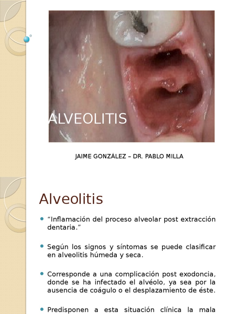 alveolitis-130527180045-phpapp02 | Especialidades Medicas | Enfermedades y trastornos