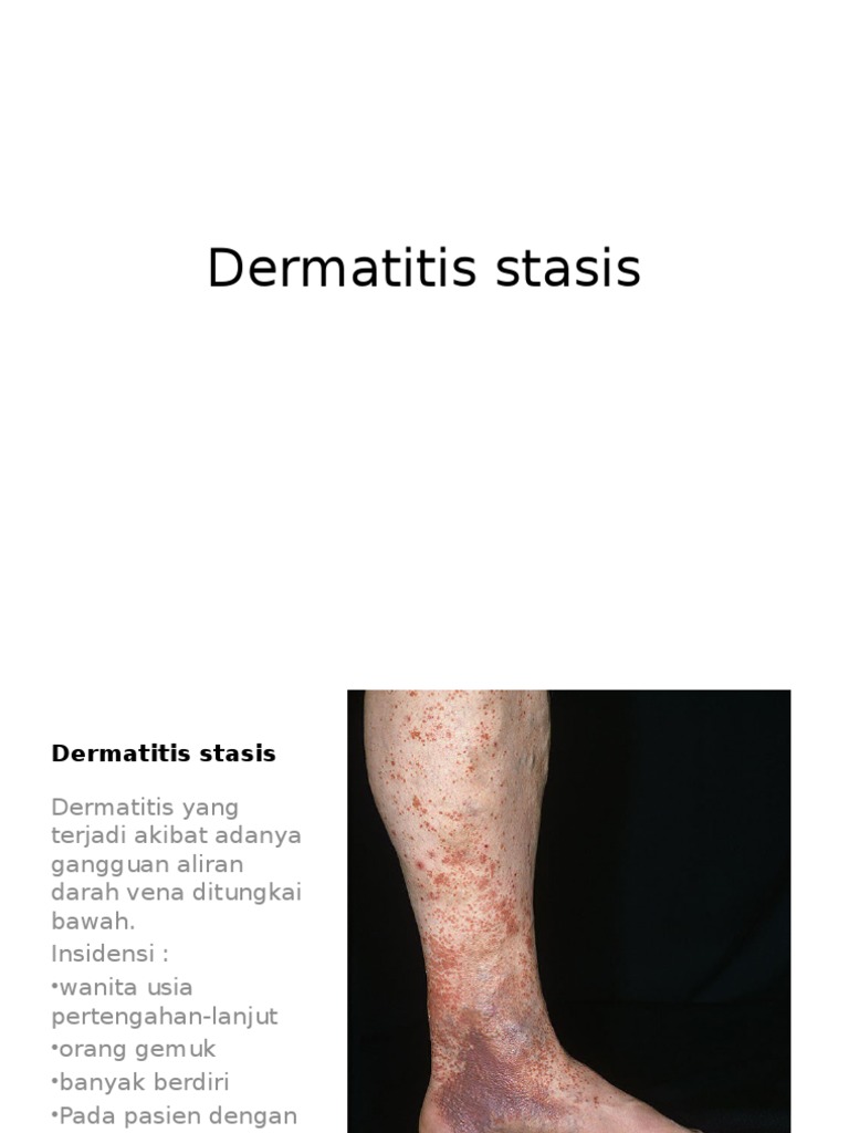 Tatalaksana dan Diagnosis Dermatitis Stasis | PDF