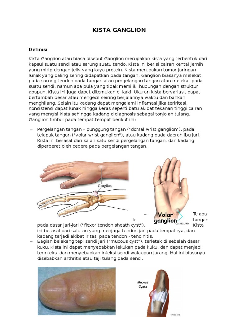 Kista Ganglion Idk | PDF