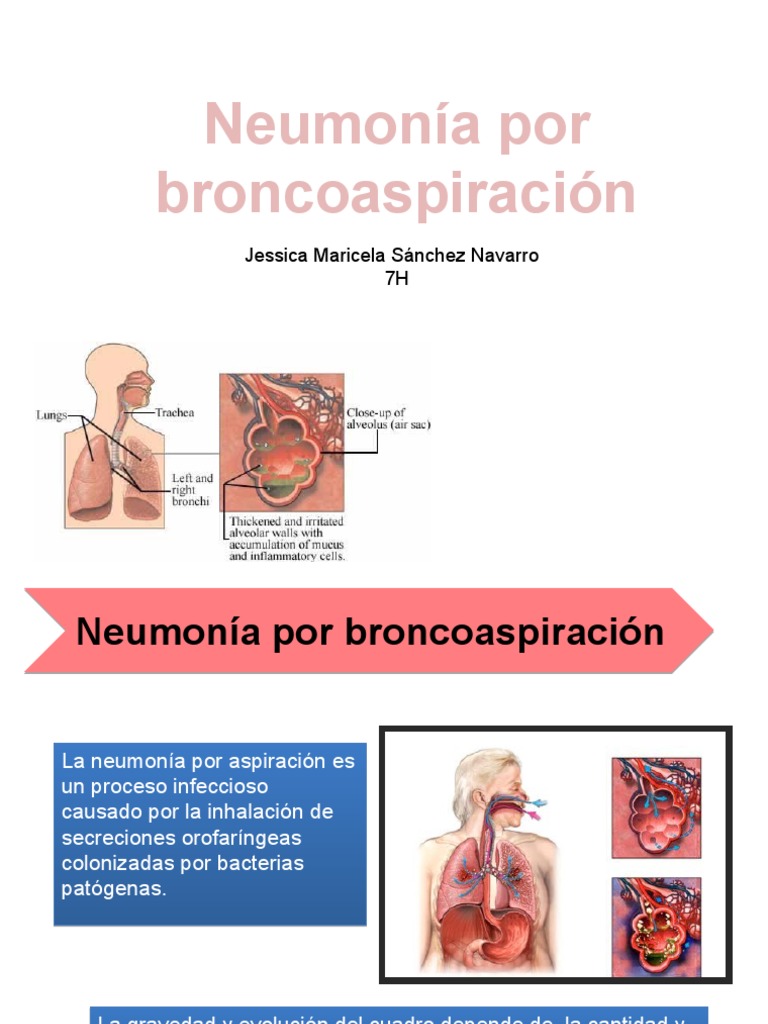 Neumonia Por Broncoaspiracion | Neumonía | Infección