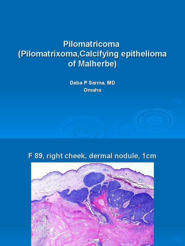 Pilomatricoma (Pilomatrixoma) - F 89, Right Cheek. | PDF