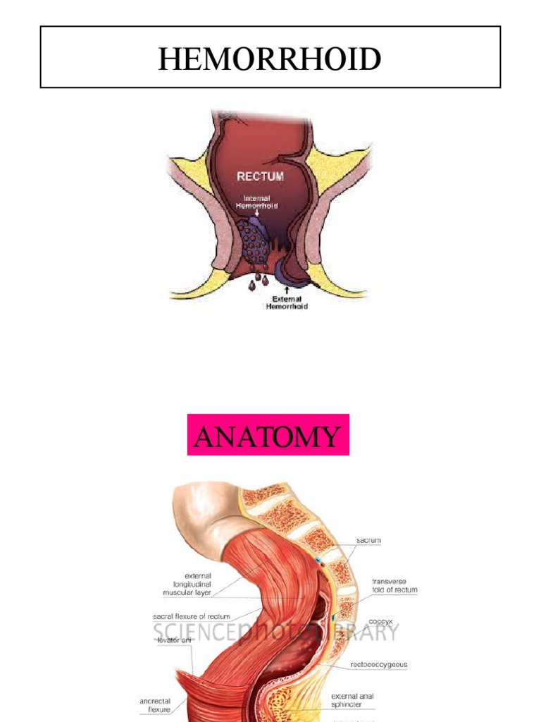 Hemorrhoid | PDF