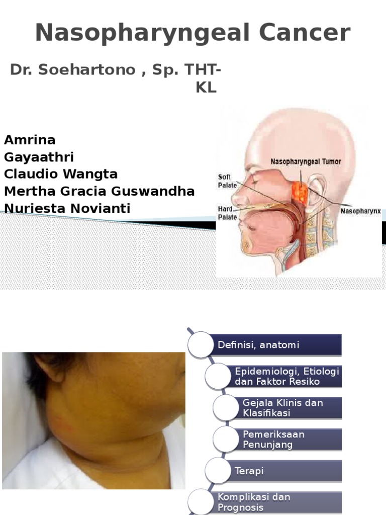 Karsinoma Nasofaring | PDF