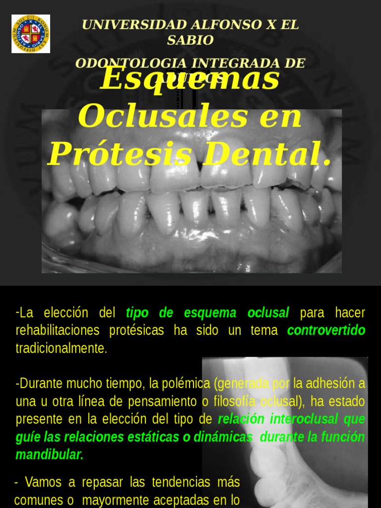 Esquemas Oclusales en Prótesis Dental | PDF | Dentadura postiza ...