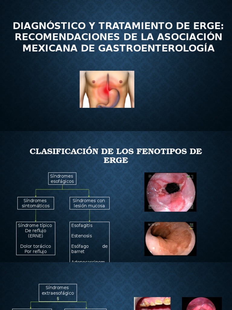 Diagnóstico y Tratamiento de ERGE | PDF | La enfermedad por reflujo gastroesofágico | Ciencias ...