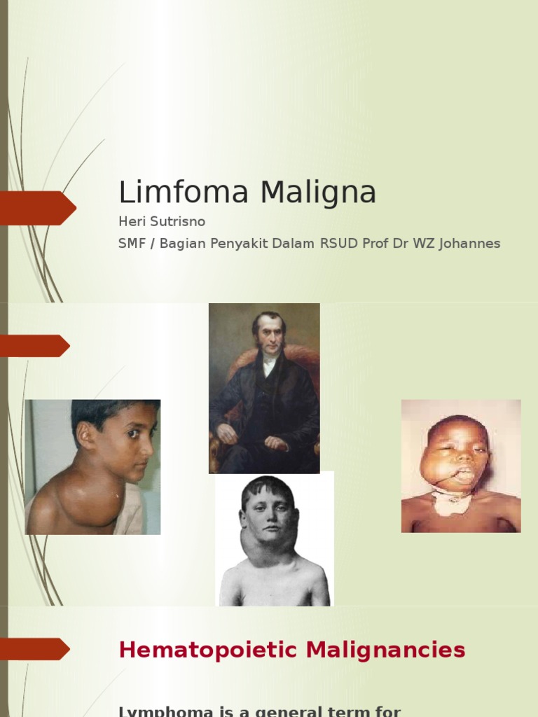 Overview of Malignant Lymphoma | PDF | Lymphoma | Lymphatic System
