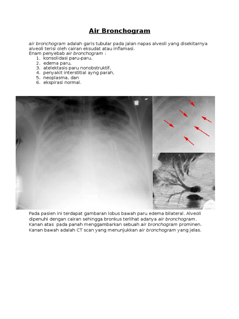 Air Bronchogram | PDF