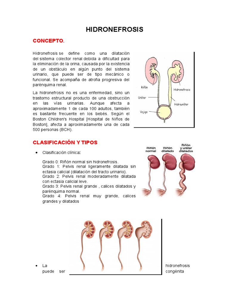 Hidronefrosis Sistema Genitourinario órgano Anatomía