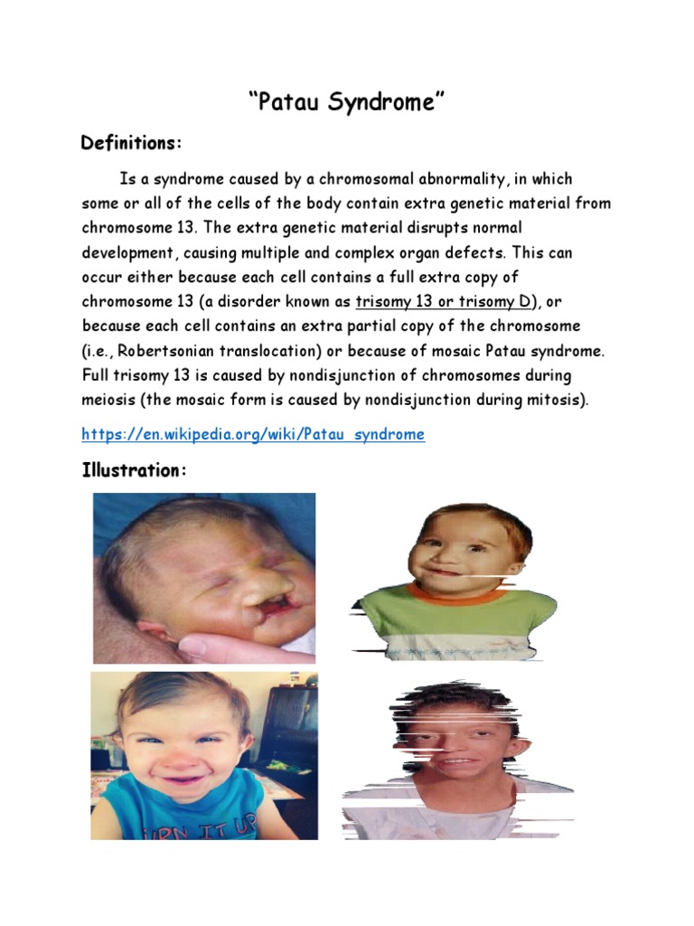 Patau Syndrome Symptoms Pictures