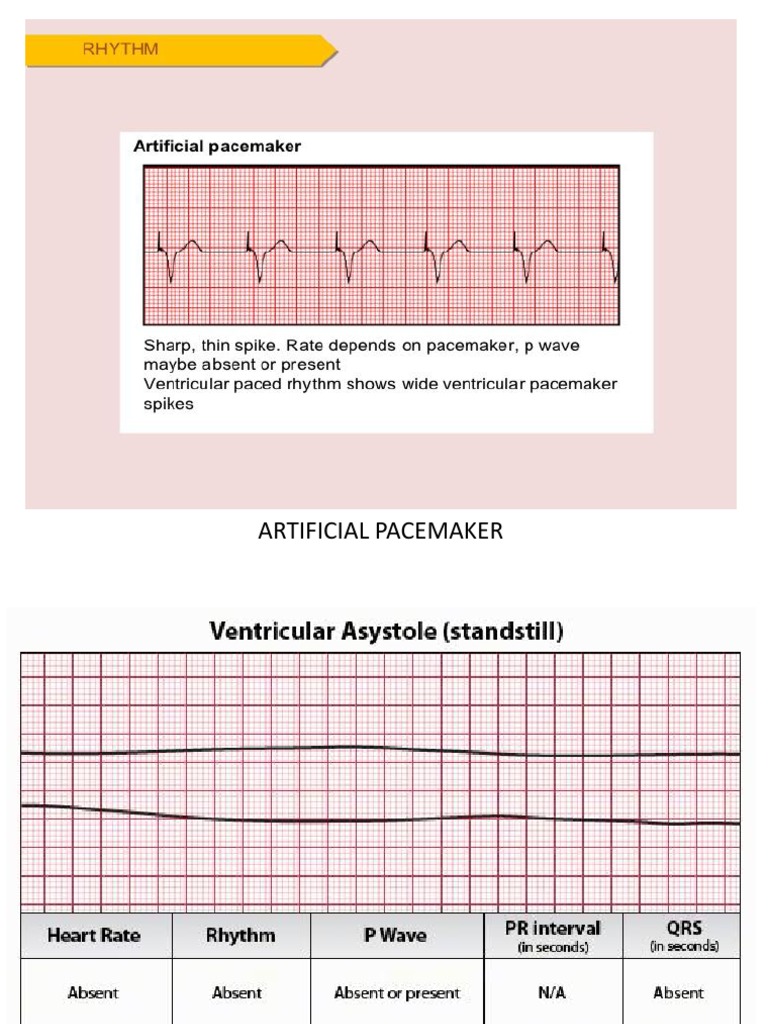 ECG Strips for Cardiac Arrhythmias | PDF