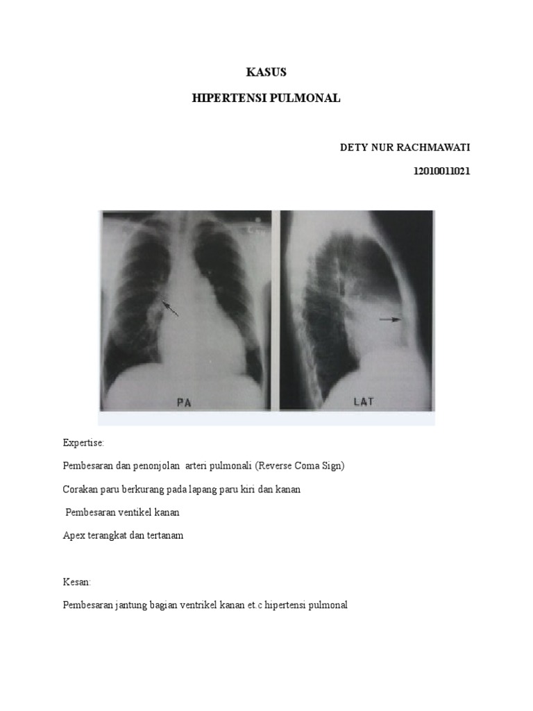 Crs 1 Radiologi Hypertension Pulmonal (Dety) | PDF