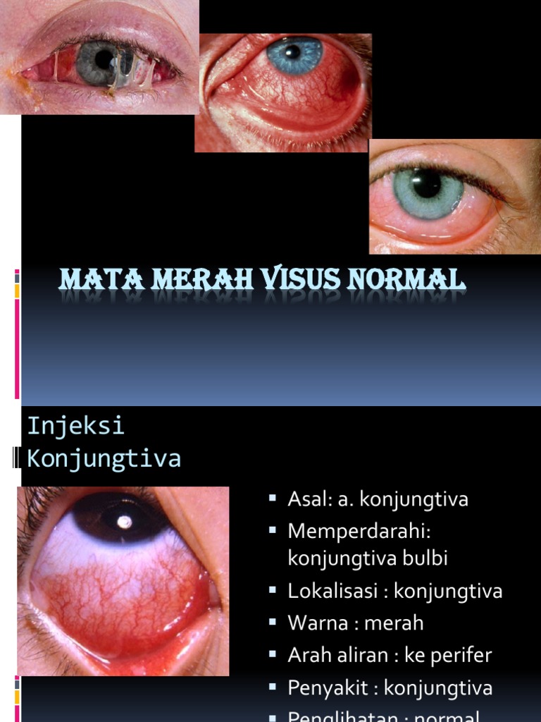 Mata Merah Visus Normal | PDF