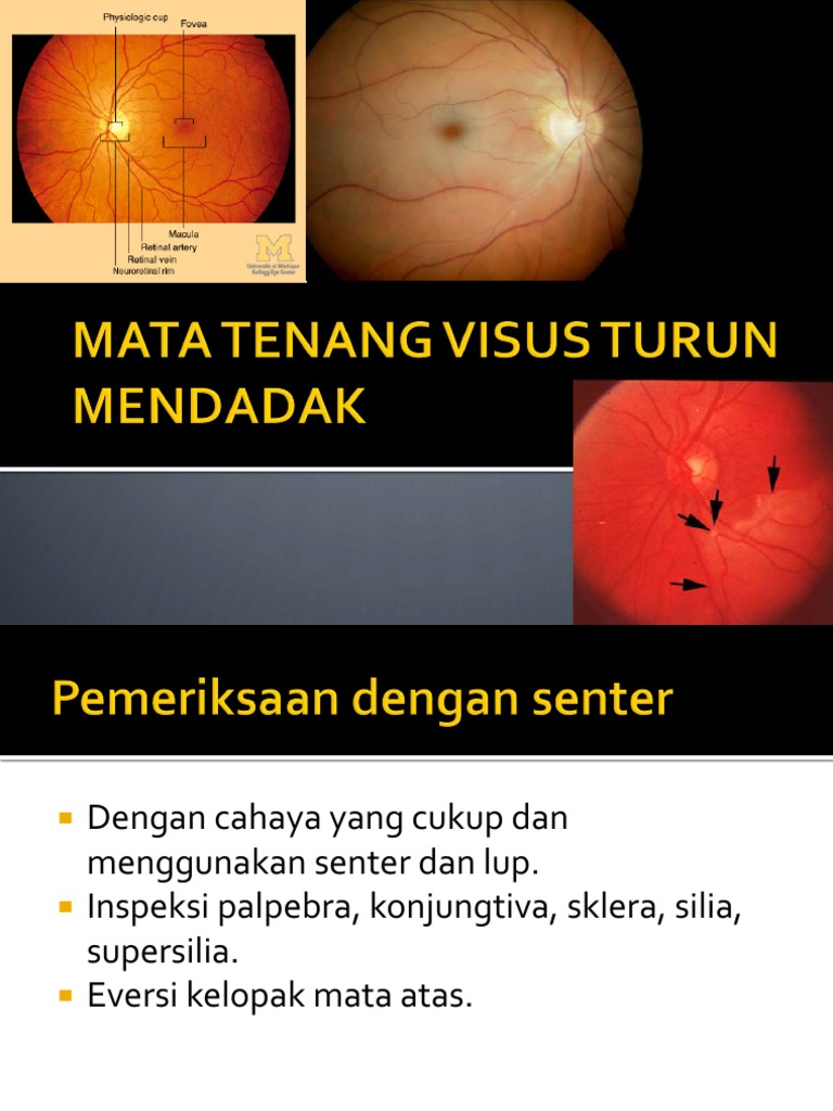 Mata Tenang Visus Turun Mendadak | PDF