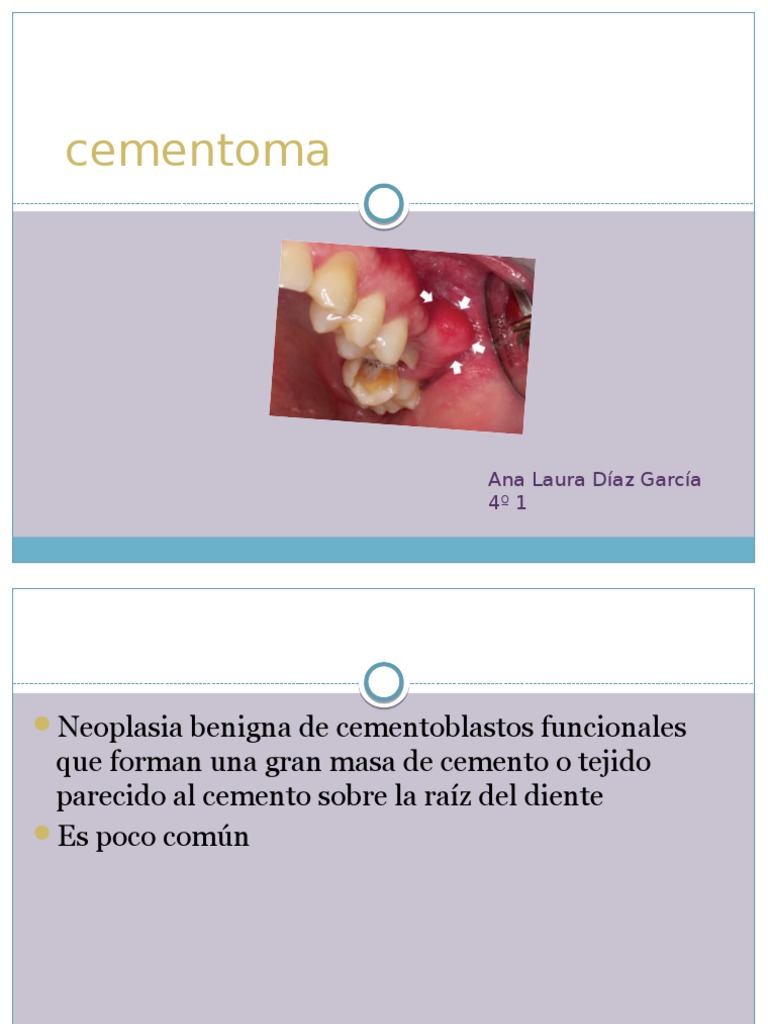 Cementoma