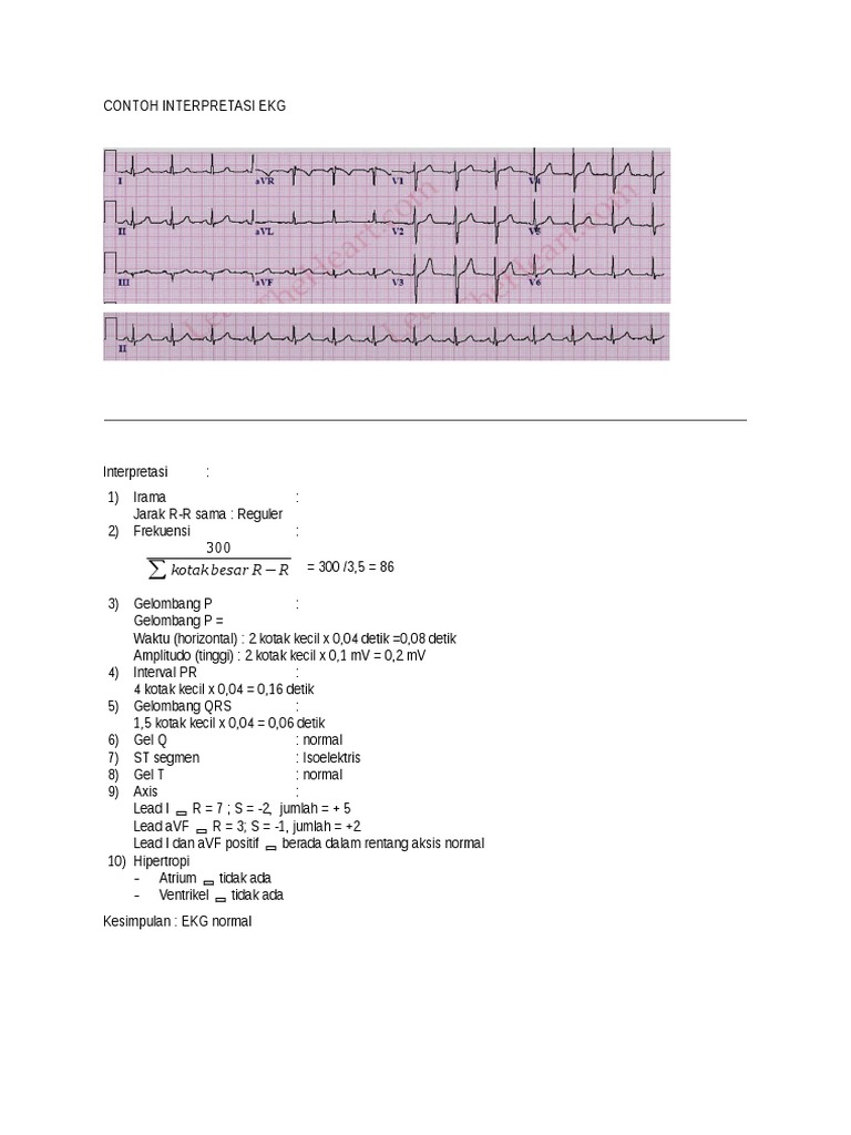 Contoh Interpretasi Ekg | PDF