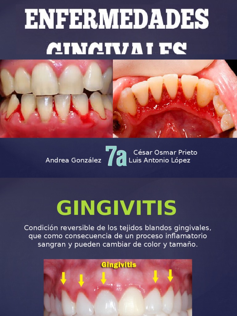 enfermedades gingivales | Inflamación | Herpes Simple