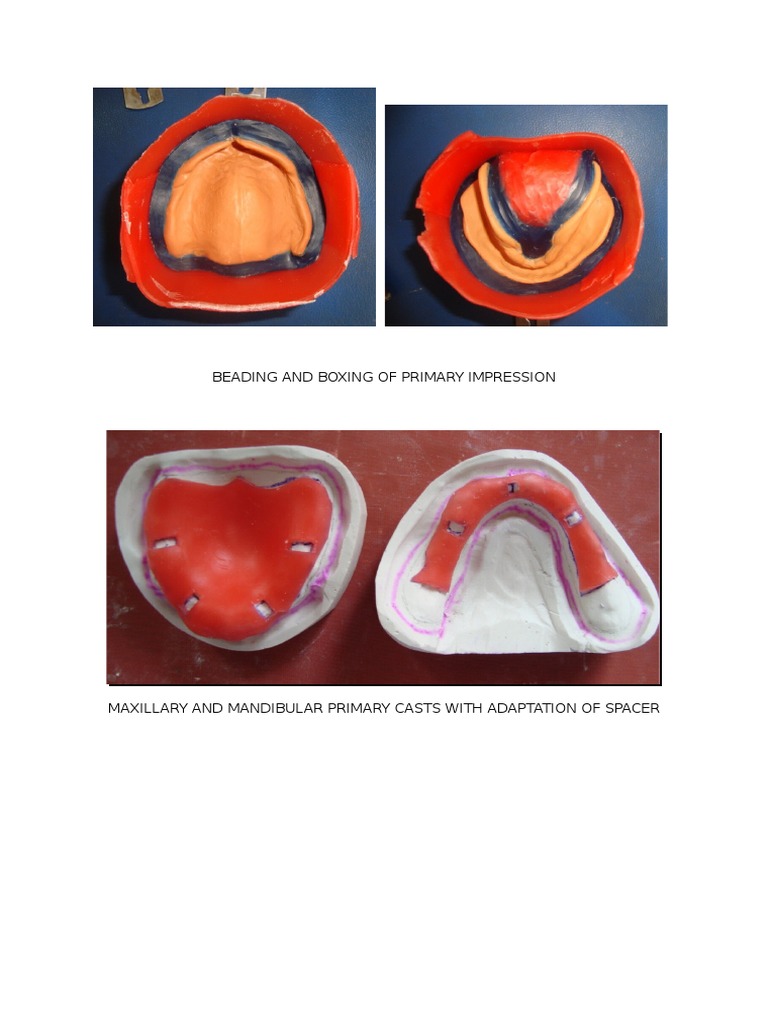 Beading and Boxing of Primary Impression | PDF