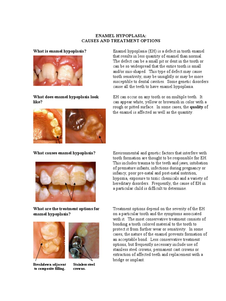 Enamel Hypoplasia | Human Tooth | Tooth Enamel