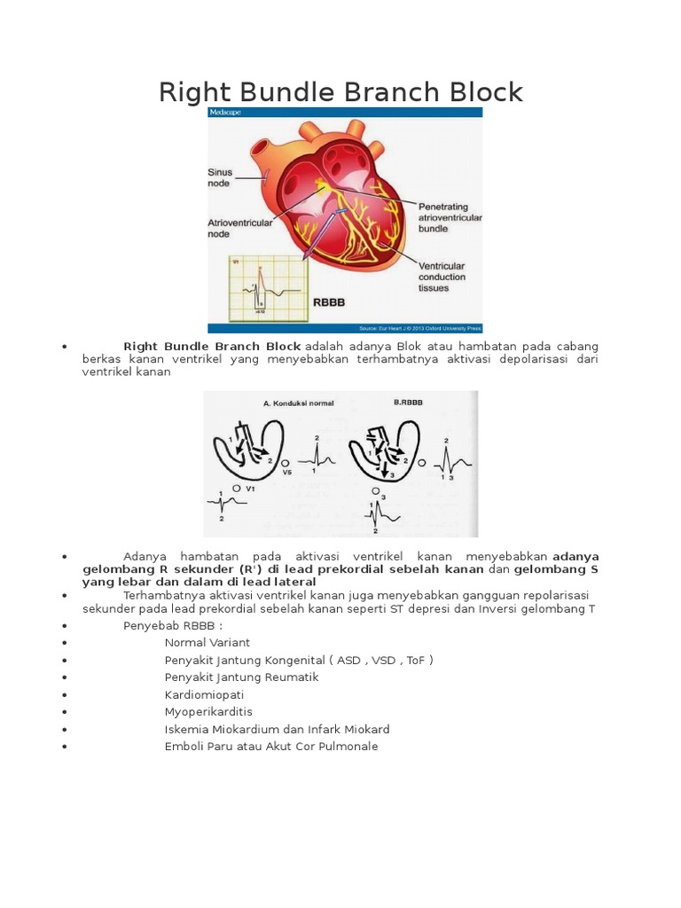 Right Bundle Branch Block: A Conduction Abnormality Affecting the Right ...