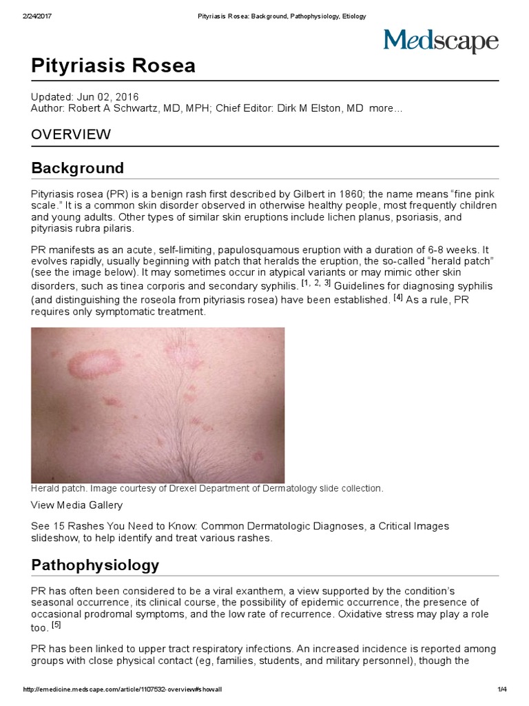 Pityriasis Rosea_ Background, Pathophysiology, Etiology | Infection ...