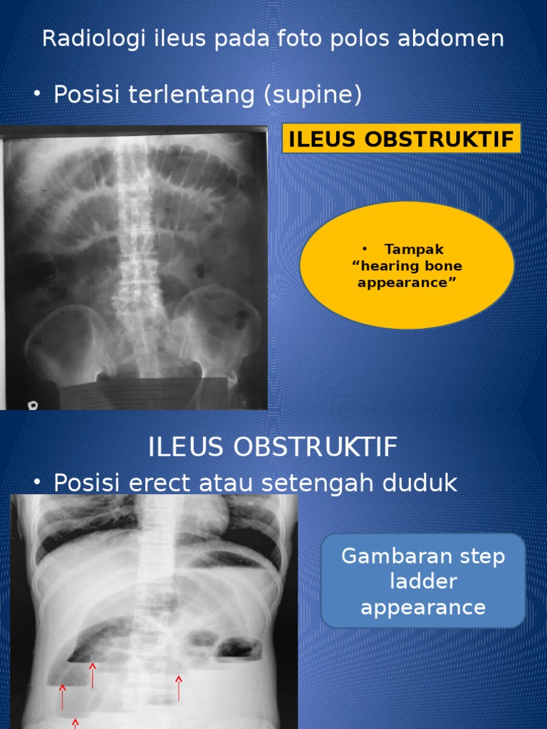 Radiologi Ileus Pada Foto Polos Abdomen | PDF