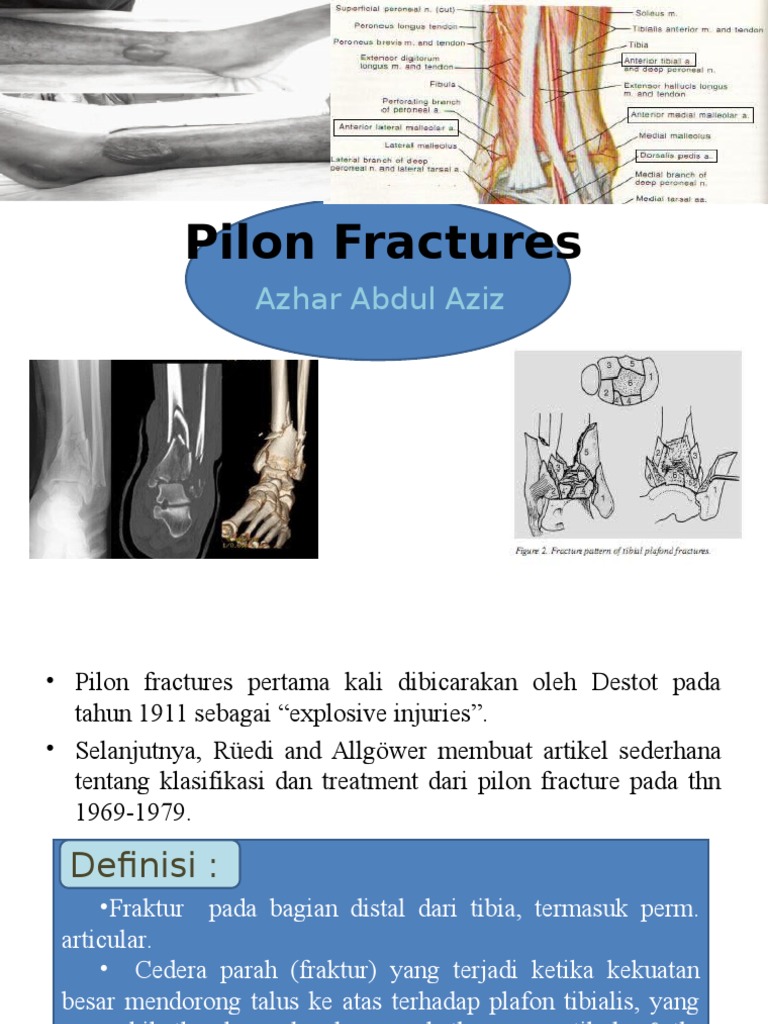 Pilon Fractures | PDF