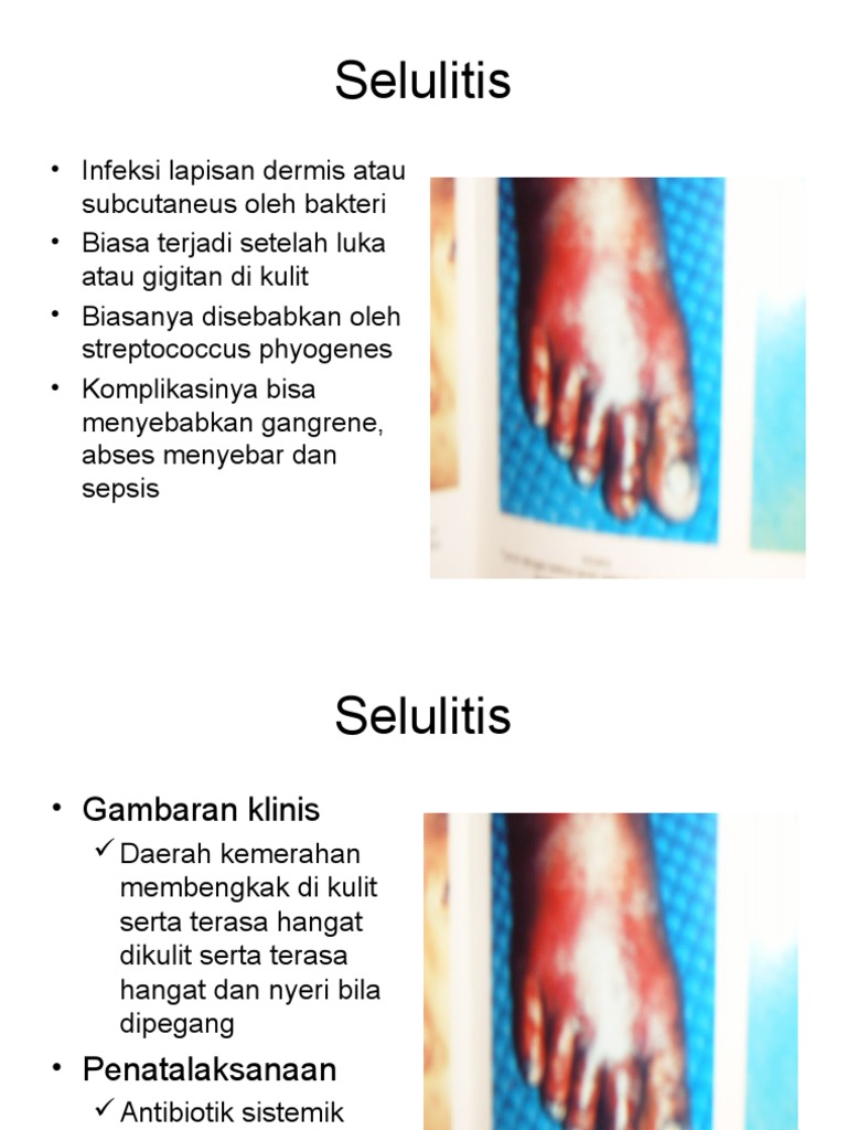 4 - Selulitis | PDF