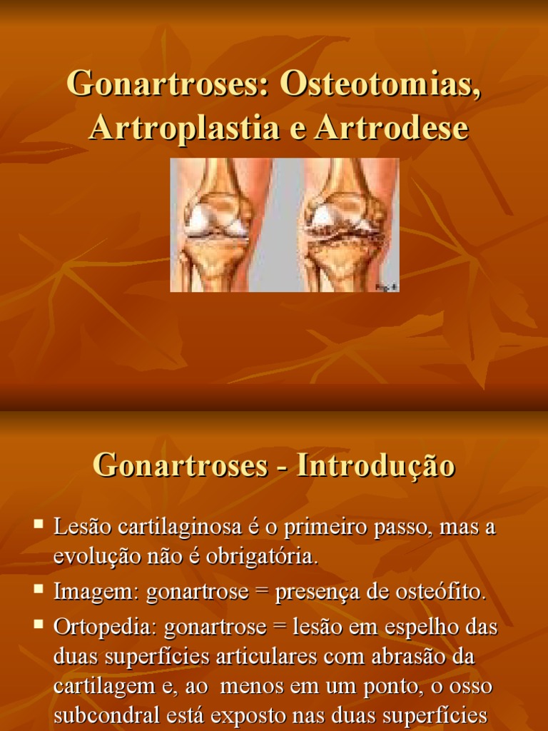 Gonartrose | PDF | Joelho | Osteoartrite