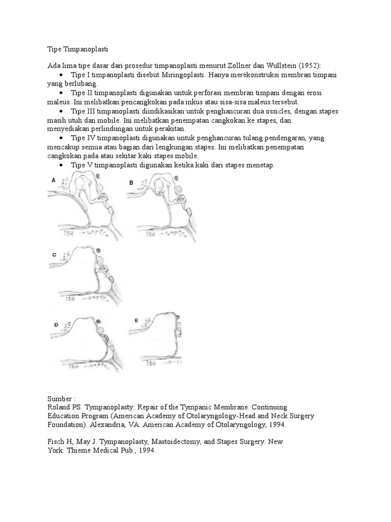 Tipe Timpanoplasti | PDF