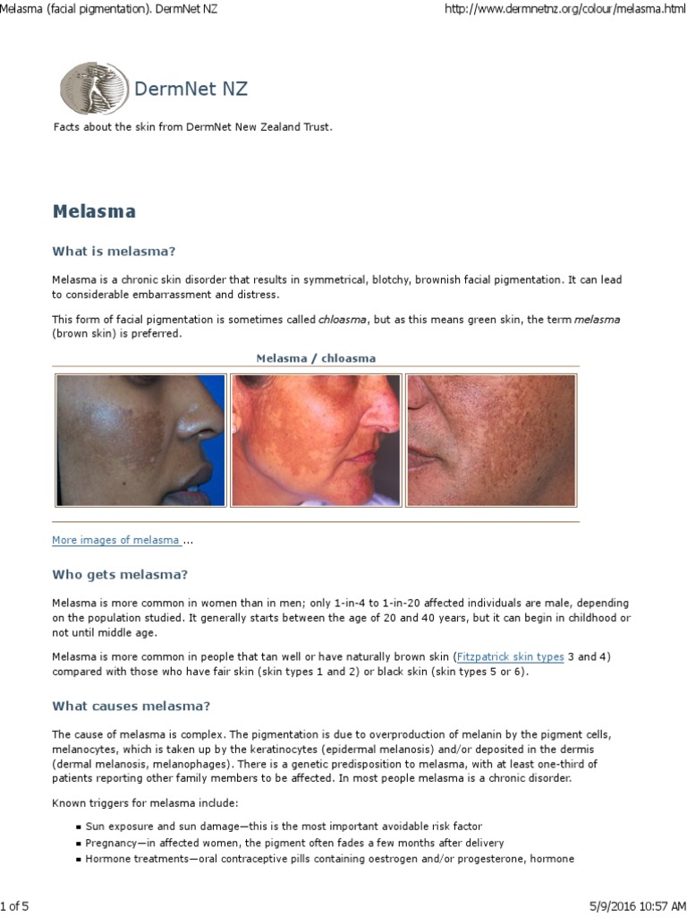 melasma | Topical Medication | Skin