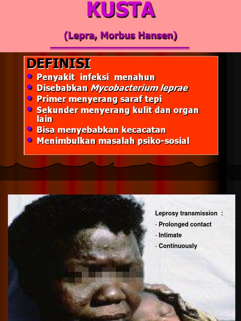 Definisi: (Lepra, Morbus Hansen) | PDF
