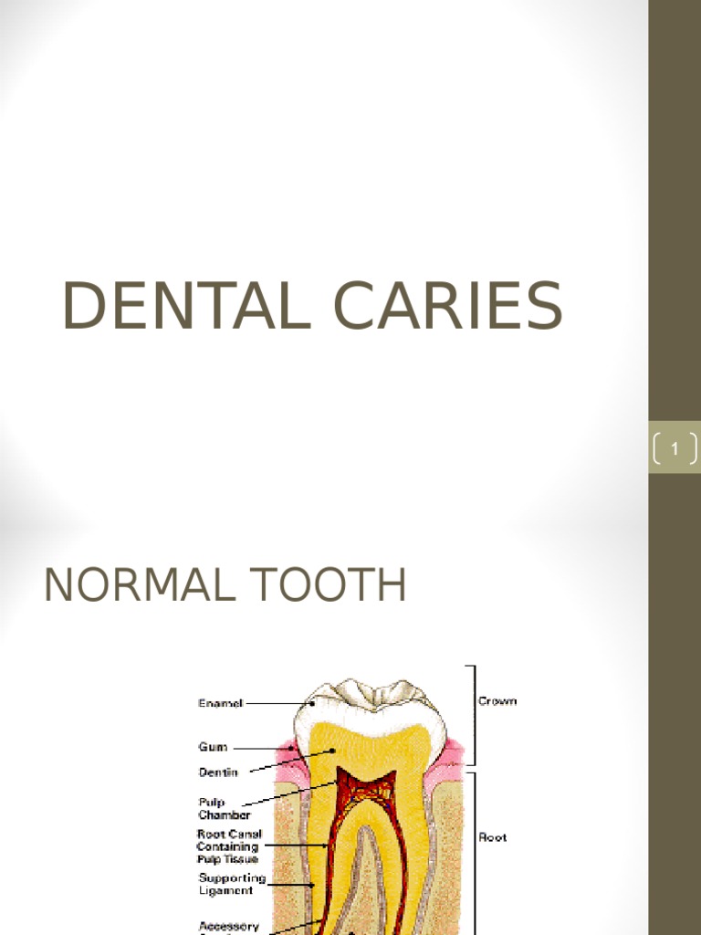dental caries.ppt | Tooth Enamel | Human Tooth