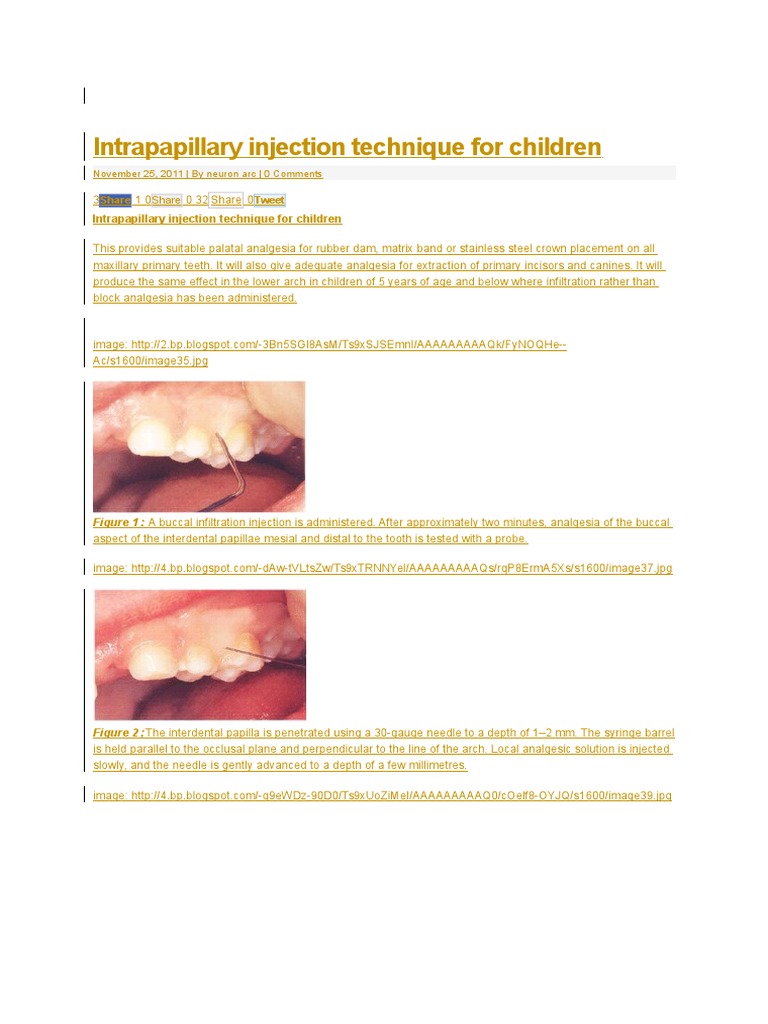 Intrapapillary Injection Technique For Children | PDF | Tooth ...
