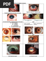 Papilledema Grading System (Frisen Scale) | PDF
