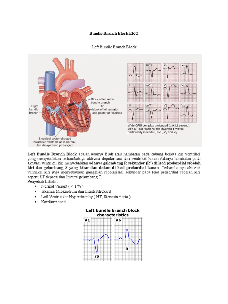 Bundle Branch Block EKG | PDF