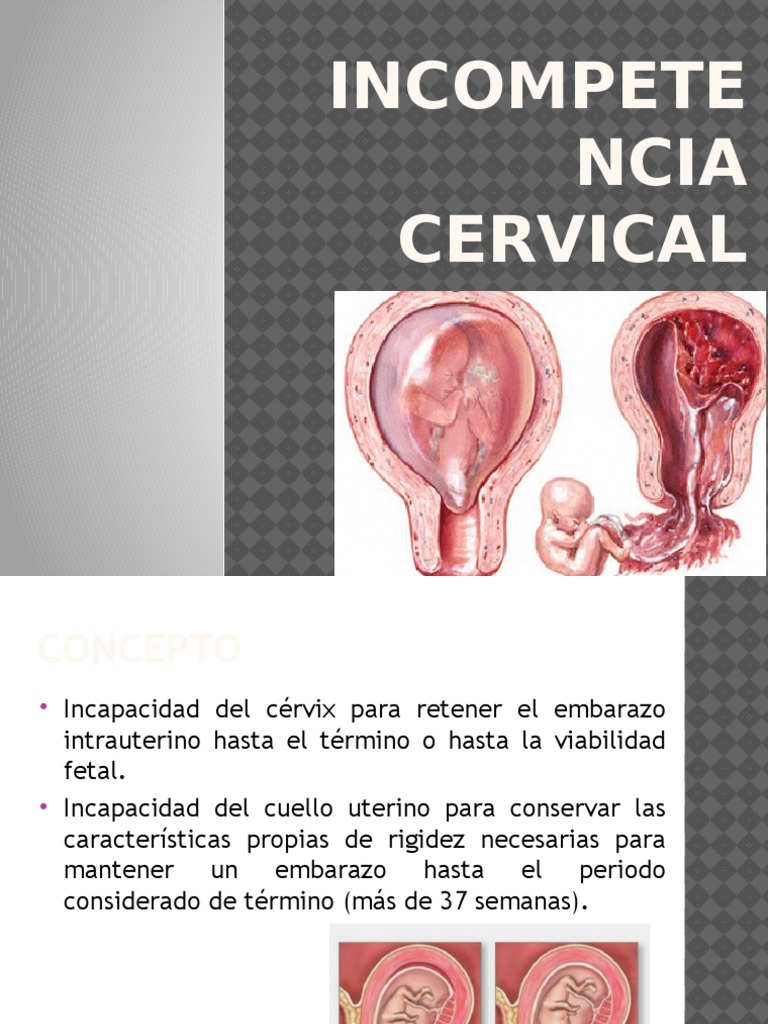 incompetencia cervical.pptx | Parto prematuro | El embarazo