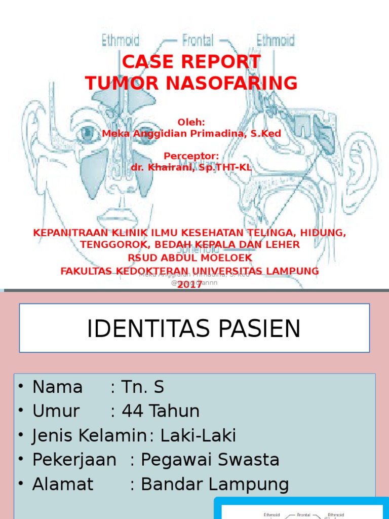 Case Report Tumor Nasofaring Meka Anggidian Primadina, S. Ked | PDF