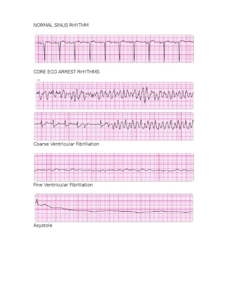 Fine Ventricular Fibrillation Vs Coarse Ventricular Fibrillation