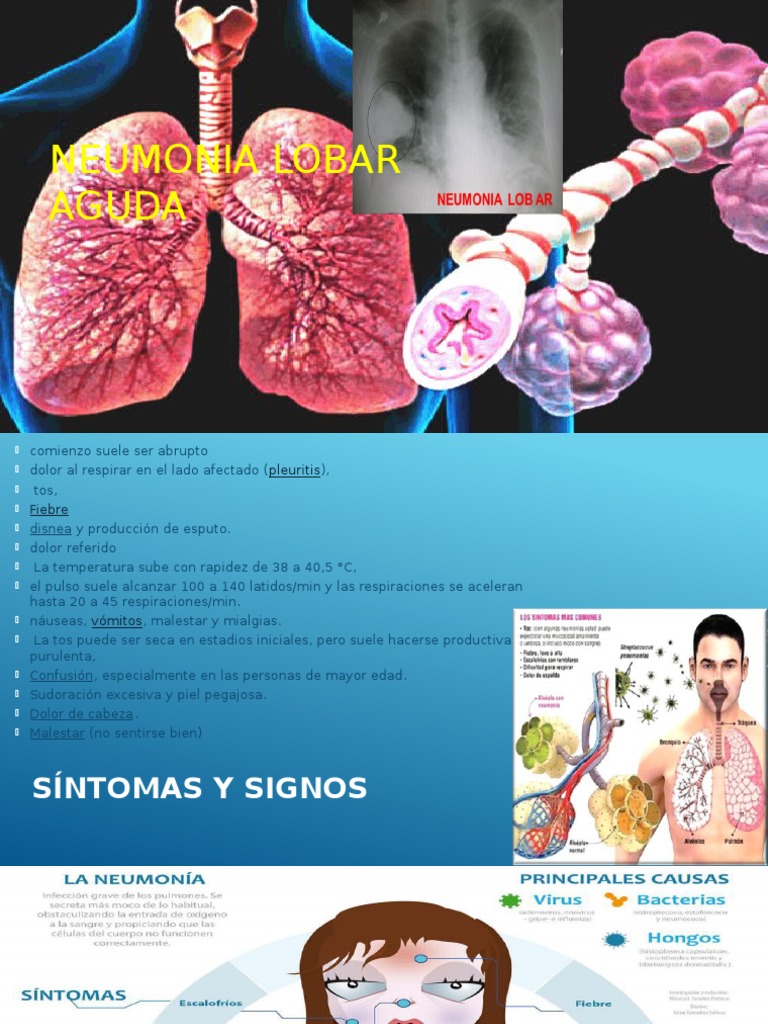 Neumonia Lobar Aguda | PDF | Neumonía | Tos