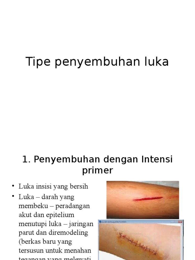 Proses Penyembuhan Luka | PDF