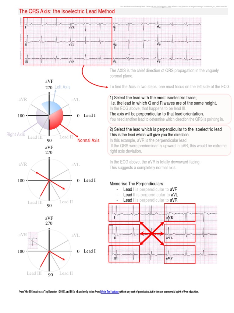 ECG Interpretation - 1 the QRS Axis the Isoelectric Lead Method ...